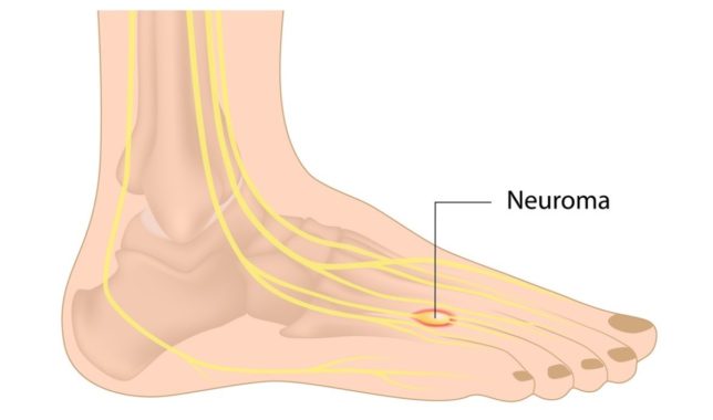 Morton’s Neuroma – Nevada Foot Institute