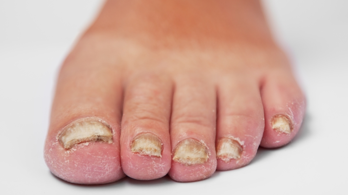 Nail Fungus – Nevada Foot Institute