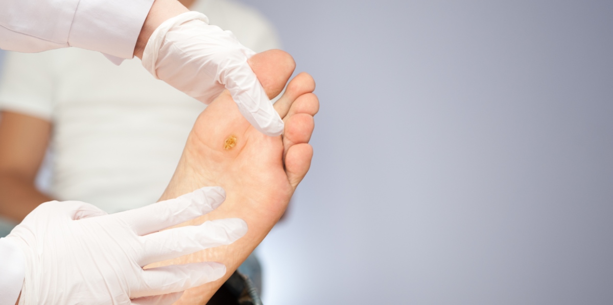 Plantar Warts – Nevada Foot Institute